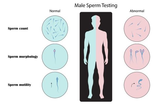 Low sperm motility: causes and treatment