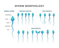 What is sperm morphology? - IVI Fertility